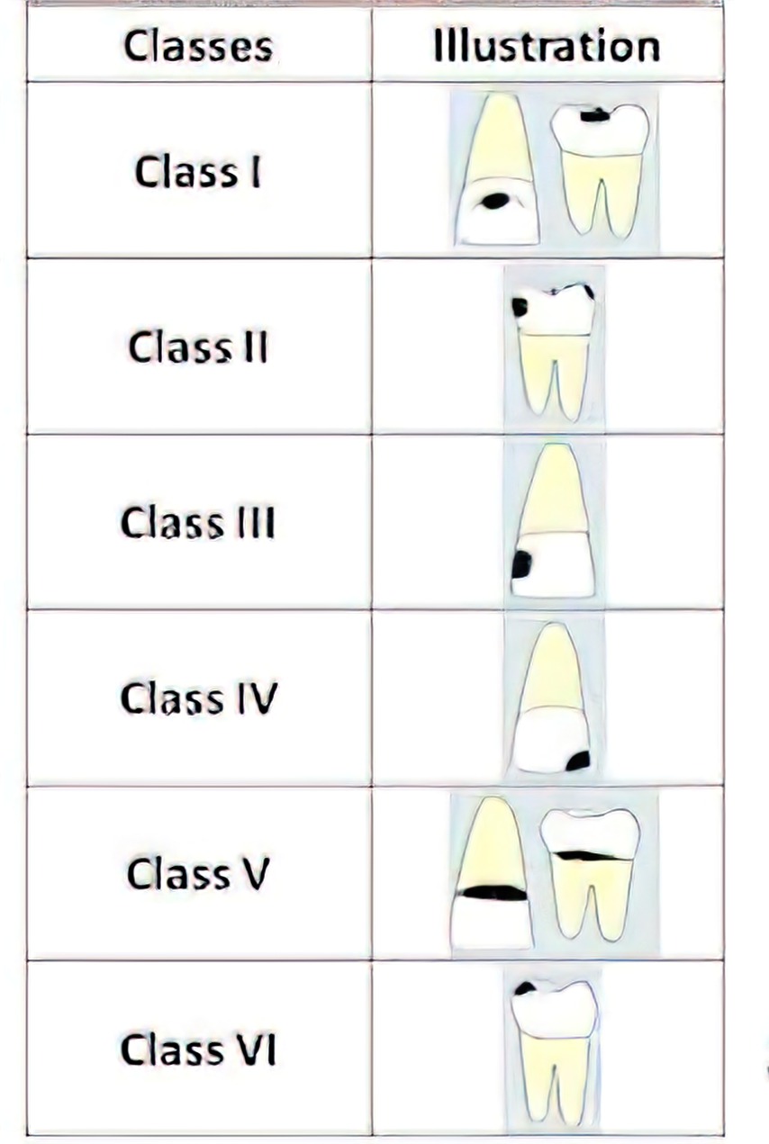 What are the Cavity Preparation? | News | BURDENTAL